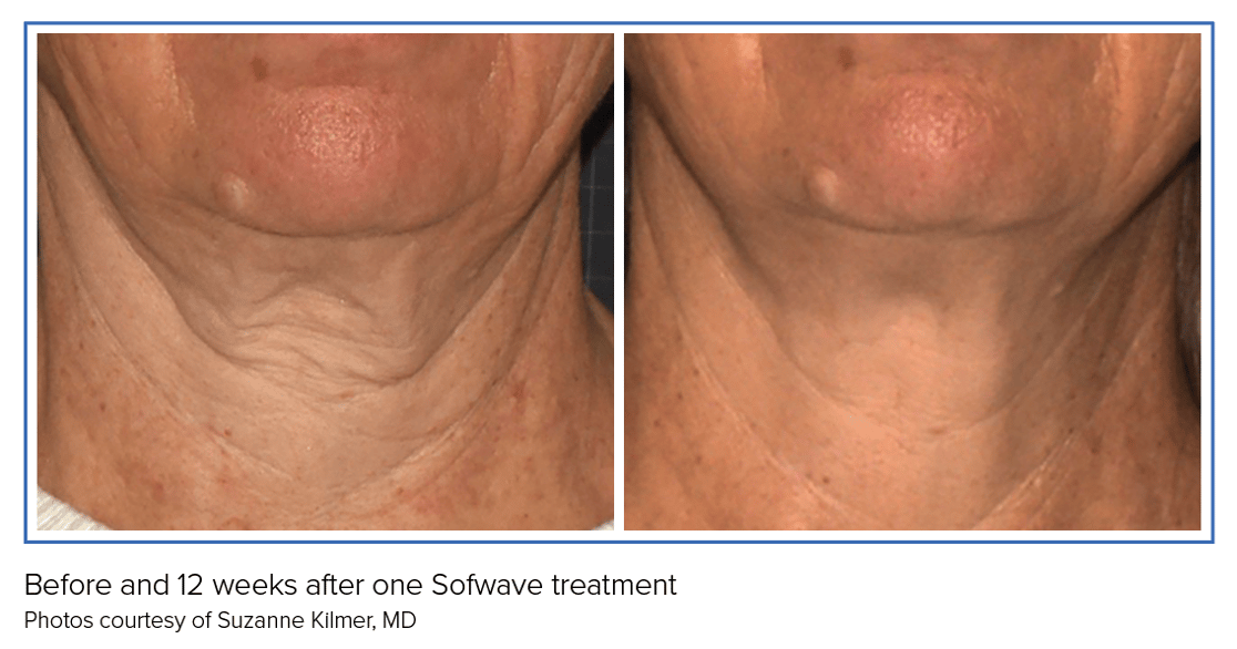 SUPERB Technology Preserves Fat During Facial Treatment