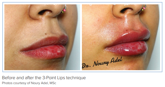 3-Point Lips Technique