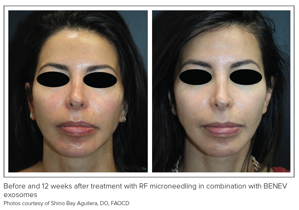 Not All Exosomes Are Created Equal: Everything You Need to Know