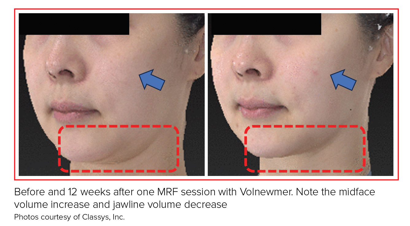 Monopolar RF Device Adds Volume to Skin Tightening Benefits