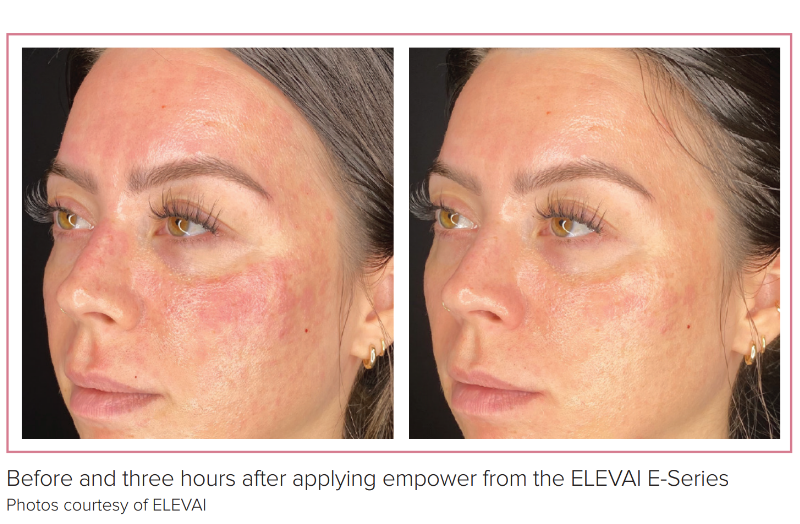 Revolutionizing Skincare: Harnessing the Potential of Regenerative ...