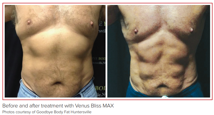 Venus Bliss MAX: Full-Service Body Sculpting with Three Technologies in ...