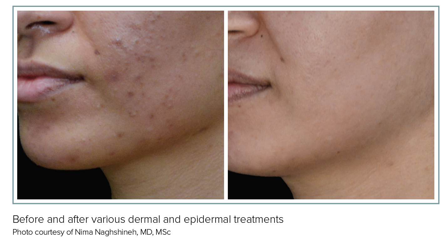 Rejuvenation by the Layer: Skin Treatment
