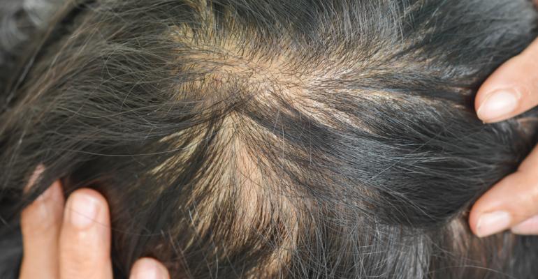 Factors that affect hair loss