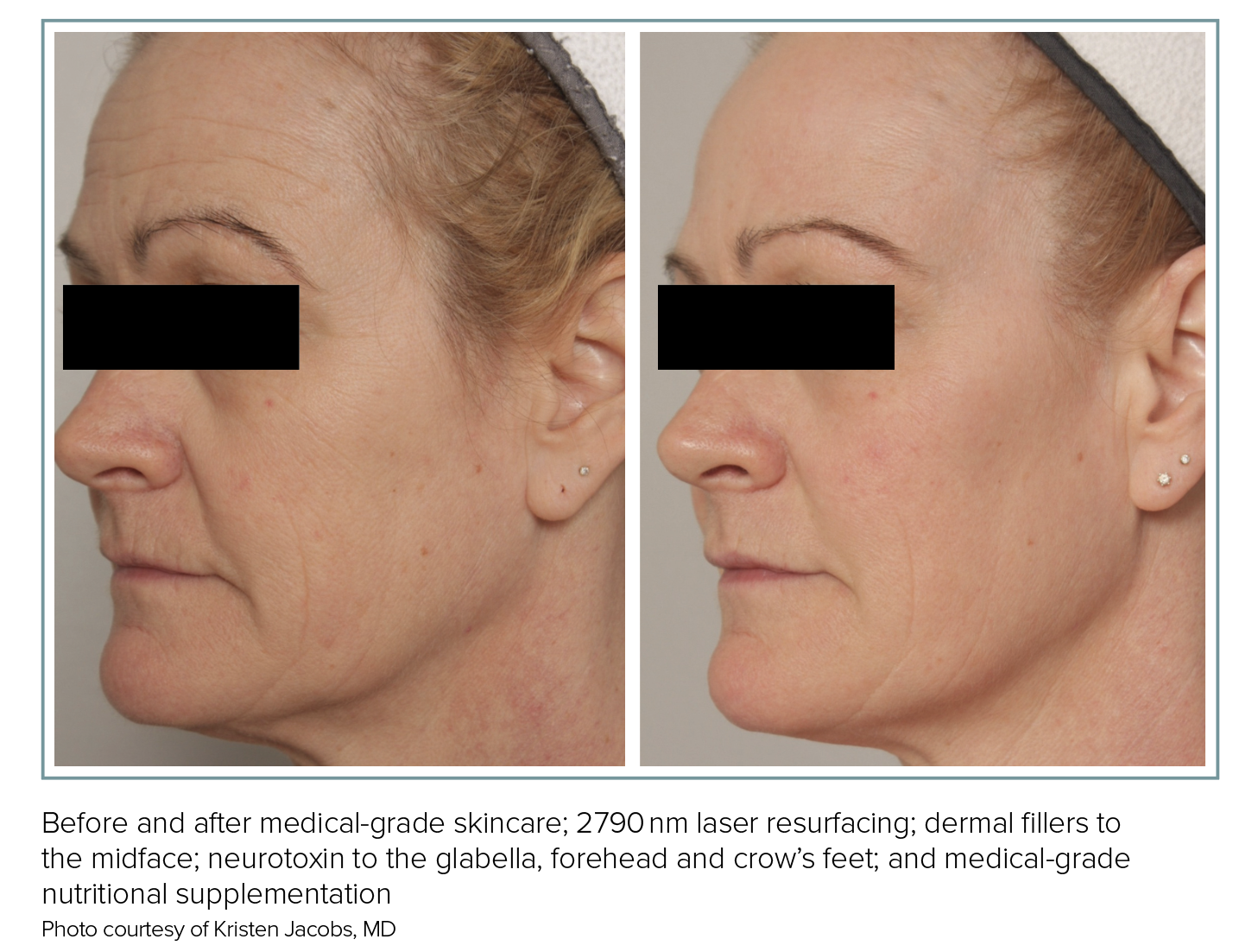 Rejuvenation by the Layer: Skin Treatment
