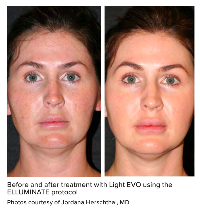 Light EVO: Versatility, Utility, Expandability and Profitability