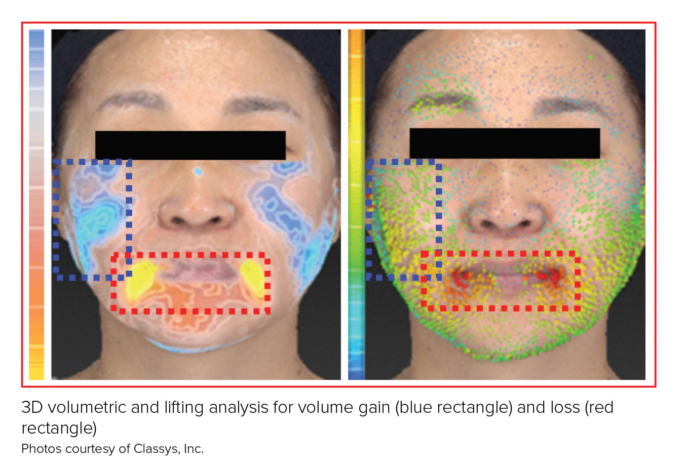 Monopolar RF Device Adds Volume to Skin Tightening Benefits