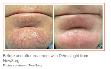 Energy-Based Devices: The Mainstays of Aesthetic Practices