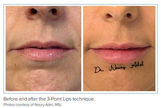 3-Point Lips Technique
