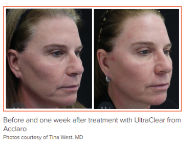 Energy-Based Devices: The Mainstays of Aesthetic Practices