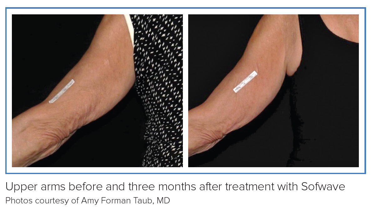 Synchronous Ultrasound Parallel Beam Technology Gains New Approval for Upper Arm Laxity