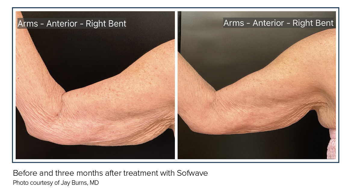 Body Shaping Technology Addresses GLP-1 Effects