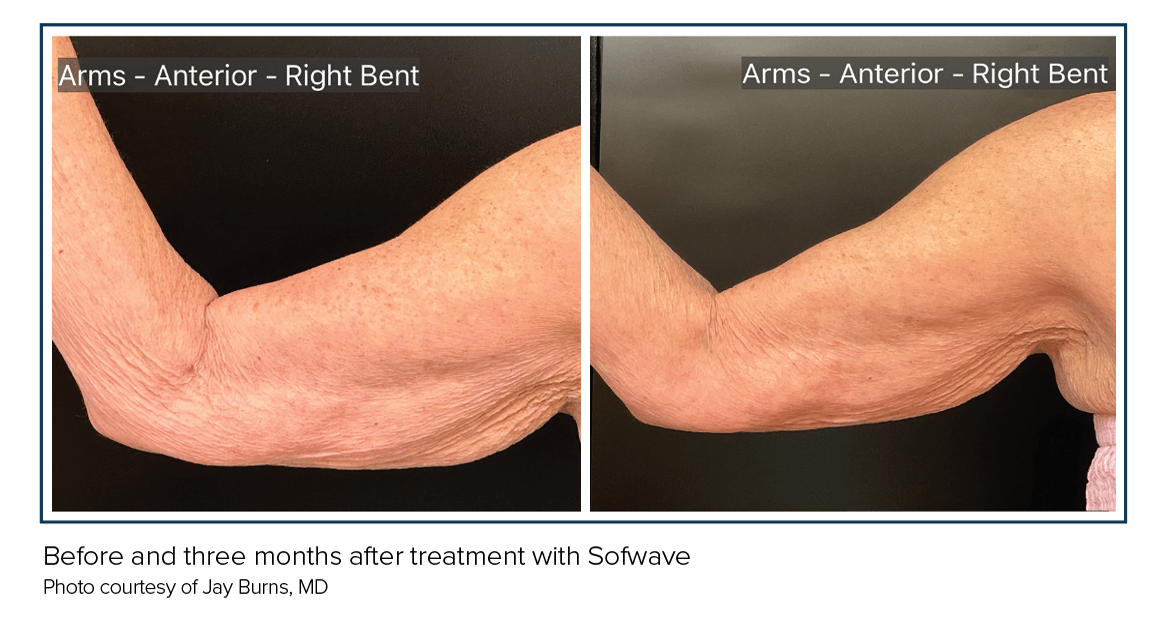 Body Shaping Technology Addresses GLP-1 Effects