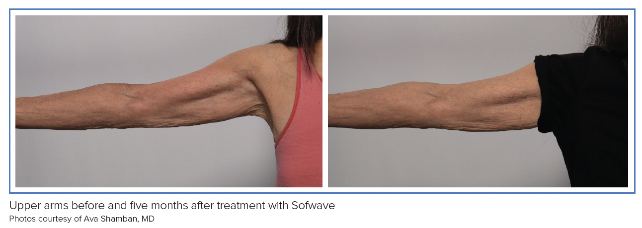 Synchronous Ultrasound Parallel Beam Technology Gains New Approval for ...