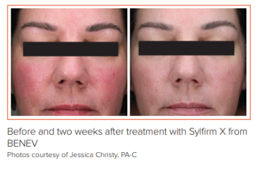 Energy-Based Devices: The Mainstays of Aesthetic Practices