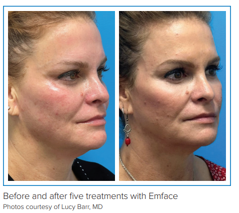 Facial Muscle Training: The Art of the Smile