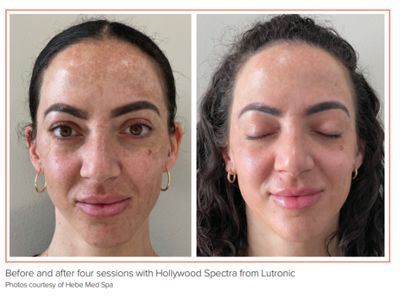 Energy-Based Devices: The Mainstays of Aesthetic Practices