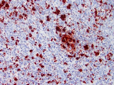 PCVAD: An Important Disease That Cannot be Forgotten