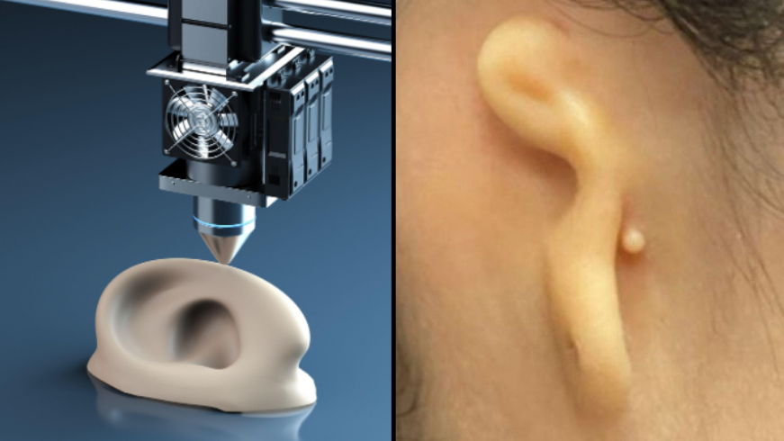 Doctors Successfully Transplant 3D Printed Ear Made Of Human Cells ...