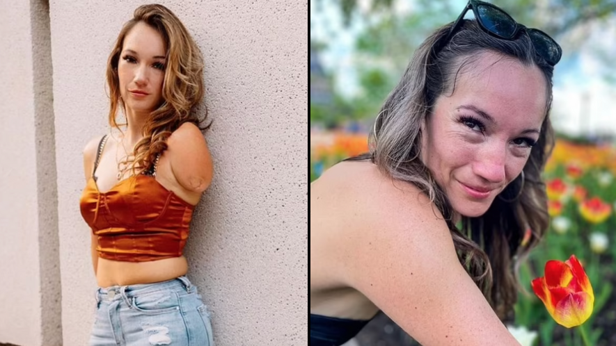 Woman born with one arm and very short legs after mum's failed abortion ...