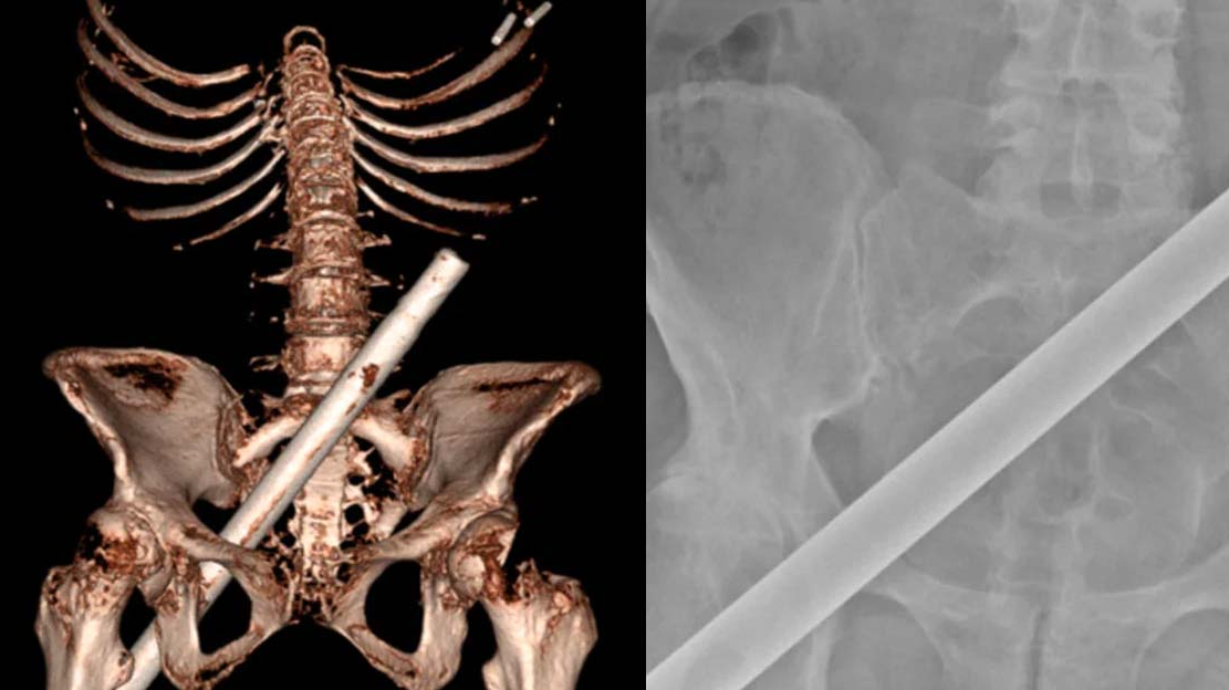 Shocking CT scans show how woman was impaled by Christmas tree ...