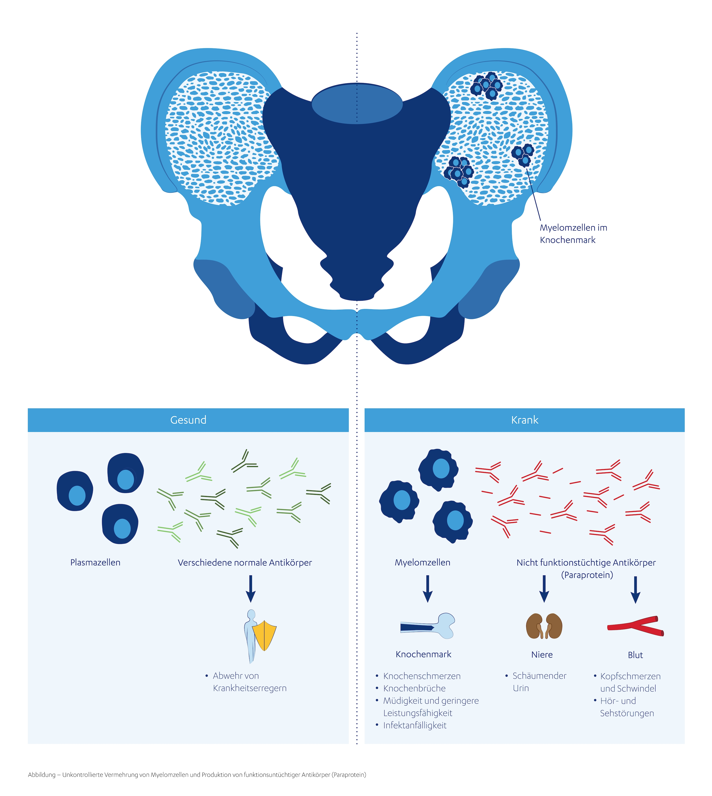 Multiple Myeloma Tedavi̇Si̇Nde Kullanilan İLaçlar – WDXMU