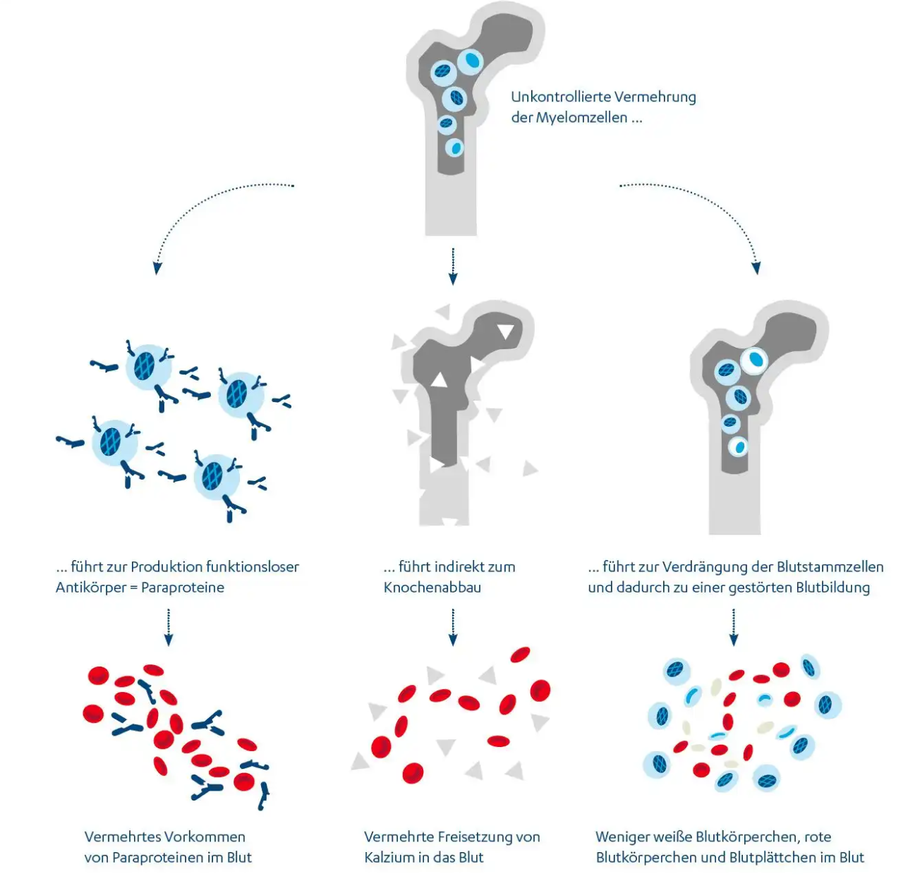 Multiplen Myeloms Symptome | Multiples Myelom: Symptome und ...