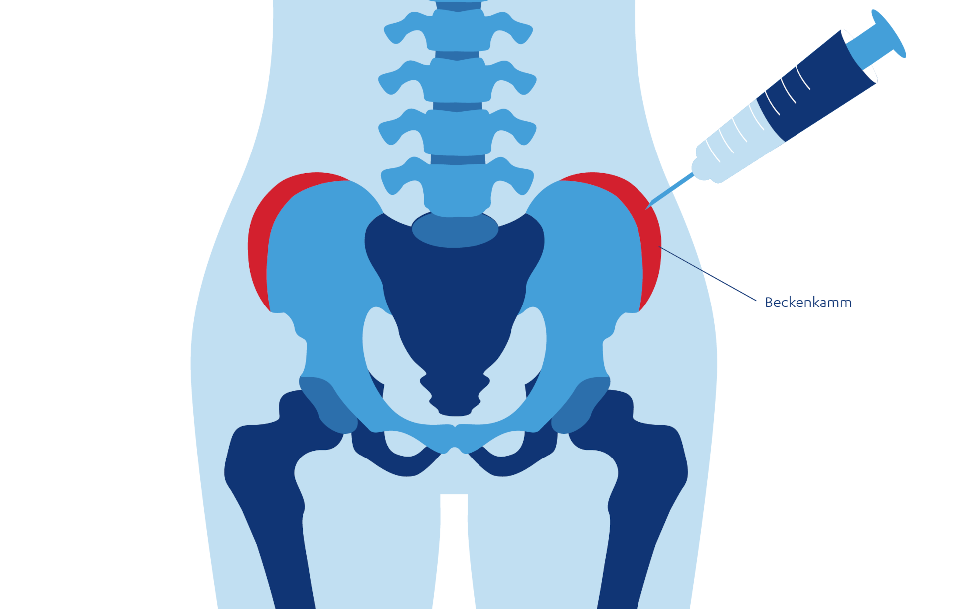 Morbus Waldenström (MW) | JanssenWithMe