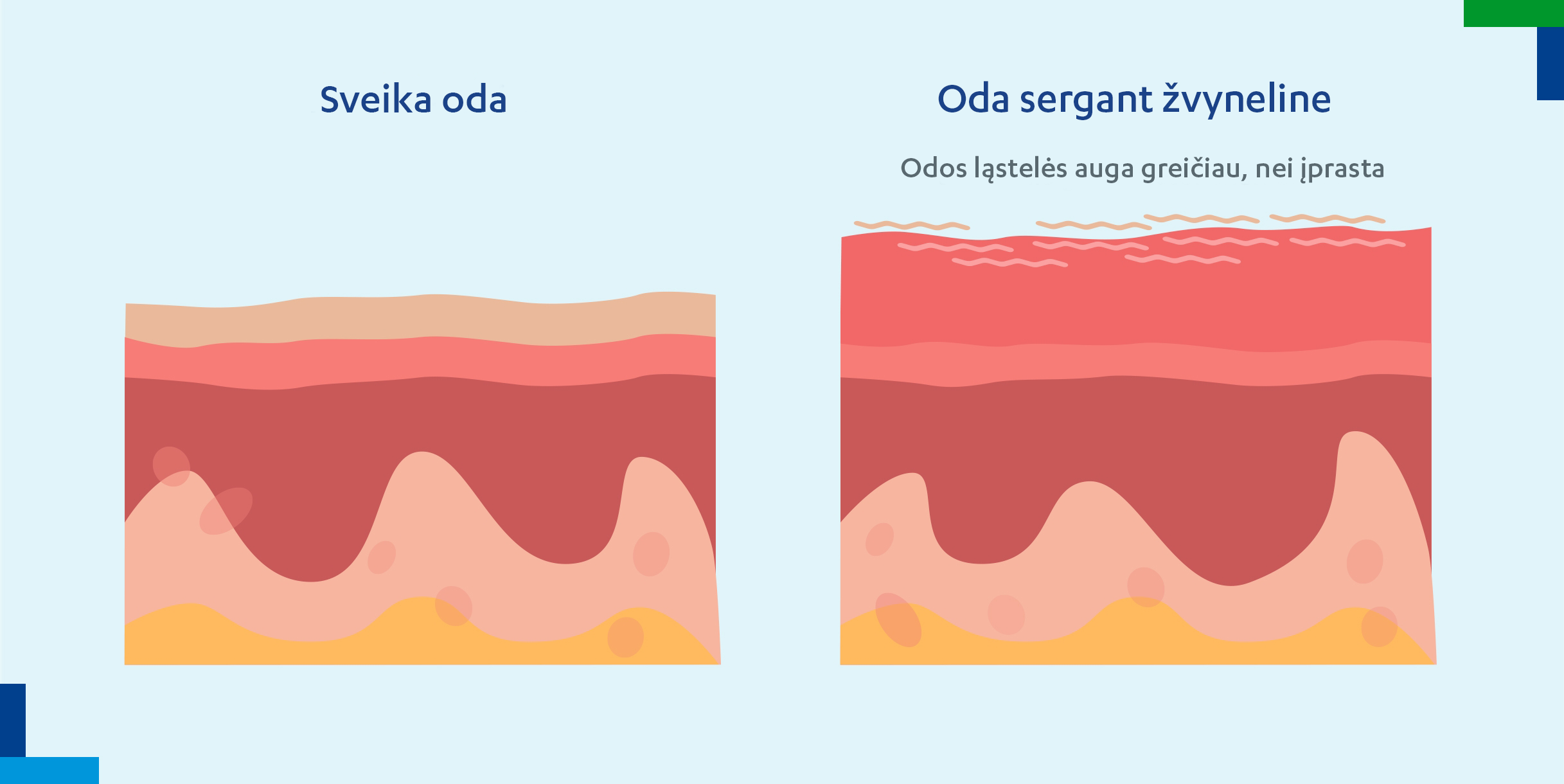 Kas yra žvynelinė? | Kas yra psoriazė?