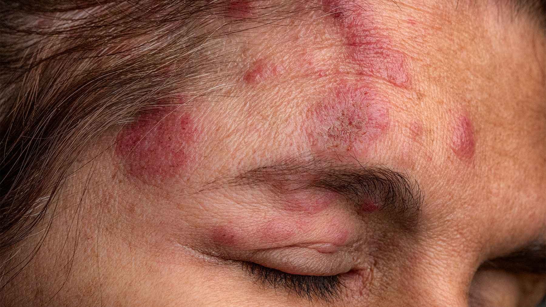 Shingles risk rises for aging farmers