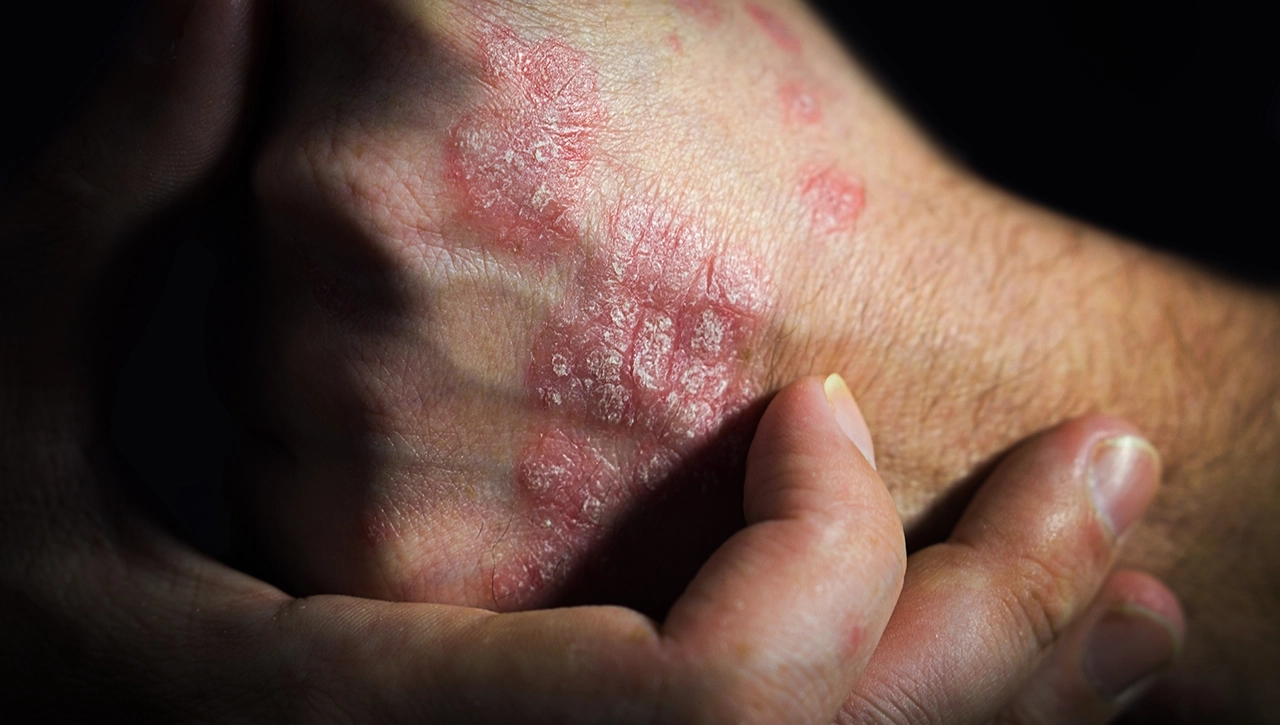 Psoriasi e cheratosi attinica | Psoriasi360